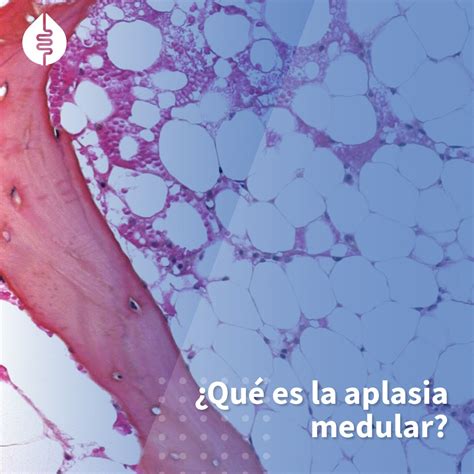 La Aplasia Medular Es Una Enfermedad En La Que La Médula ósea Roja