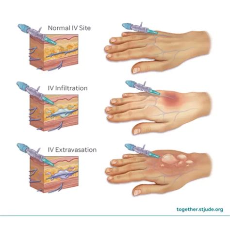 Iv Infiltration And Extravasation Together By St Jude™