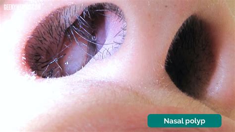 Nasal Examination Nose Examination Osce Guide Geeky Medics