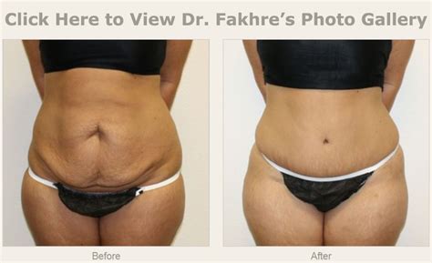 Tummy Tuck Tampa And Wesley Chapel Fl