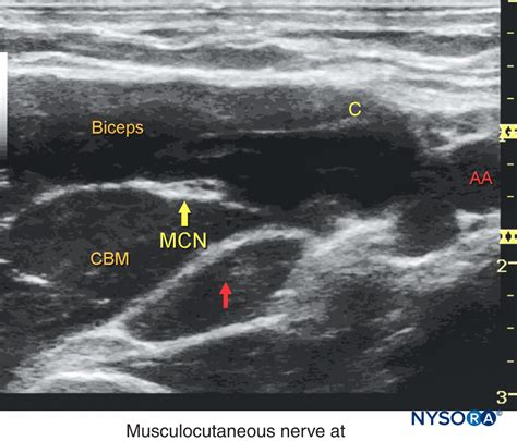 Ultrasound Guided Axillary Brachial Plexus Block Nysora