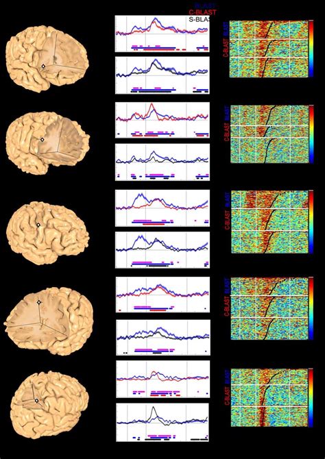 Example Of Individual Response In The Right Fronto Parietal Cortex