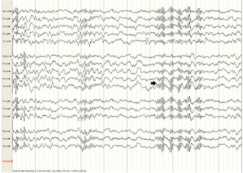 Normal Eeg Neupsy Key