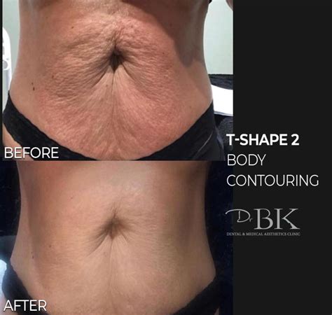 T Shape 2 Body Contouring Treatment Drbk