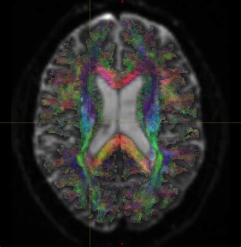 Streamlines Tractography Output Problem Mrtrix3 Community