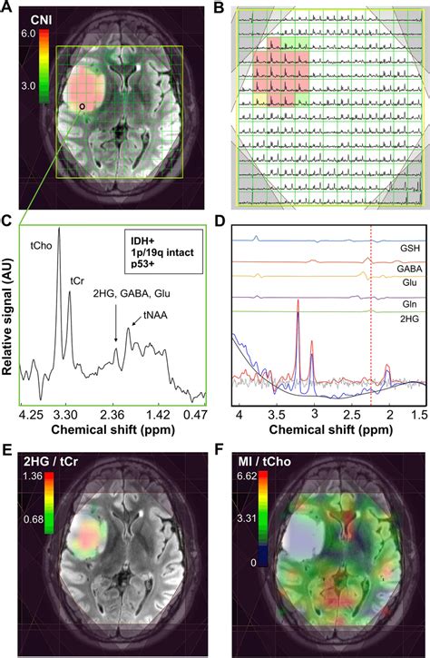 2hg specific mrsi spectral data acquired prior to surgery from a