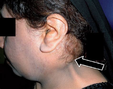 Desmoid Tumor Surgery