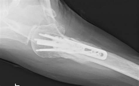 Proximal Humerus Fixation System Implants Orthobullets