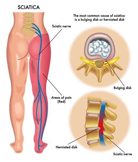 Chiropractic For Sciatica In Kl And Subang Spineplus