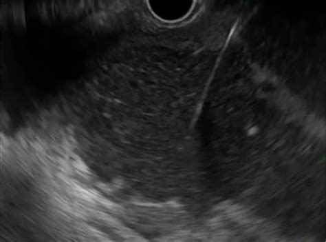 Eus Guided Image Of The Entrance To The Pancreatic Necrotic Area Via A