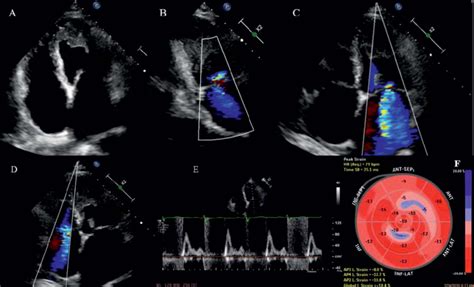 Transthoracic Echocardiography A Apical Four Chamber View Left Download Scientific Diagram