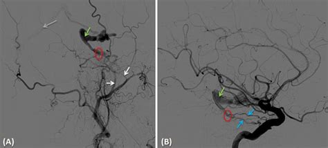 A 76 Year Old Man With A Borden 3 Davf Right Eca Angiogram Lateral