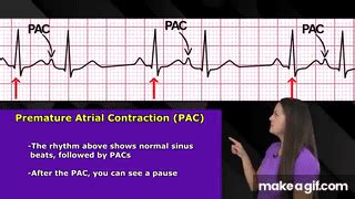 Pvcs Vs Pacs Vs Pjcs Rhythms Ecg Interpretation Compilation Nursing