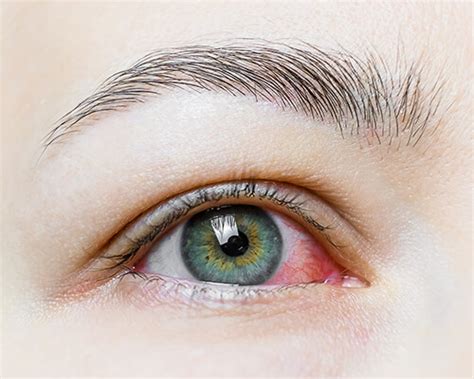 Eye Bacterial Infection