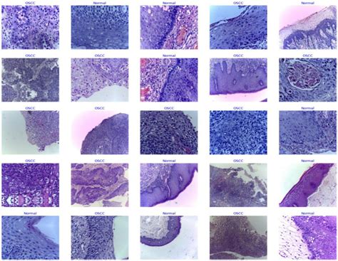 Oral Squamous Cell Carcinoma Detection Using Efficientnet On Histopathological Images Pmc