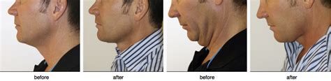 Short Scar Neck Lift Clinics In Plastic Surgery