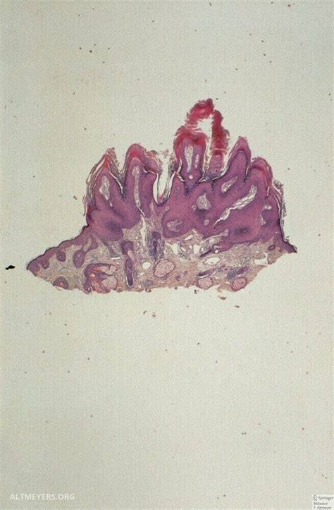 Filiform Wart Histology