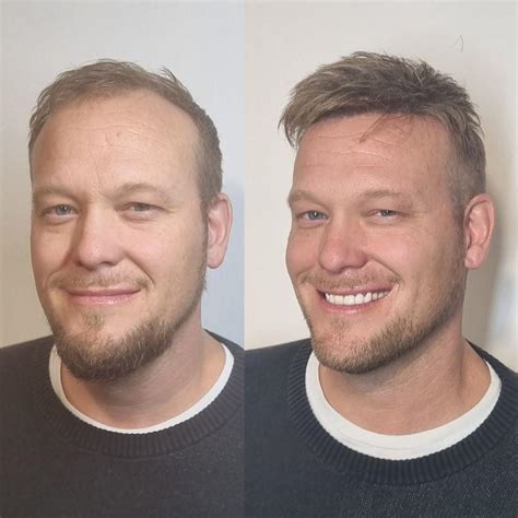Newtimes Hair Before And After