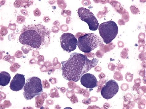 Hypergranulated Acute Promyelocytic Leukemia 4