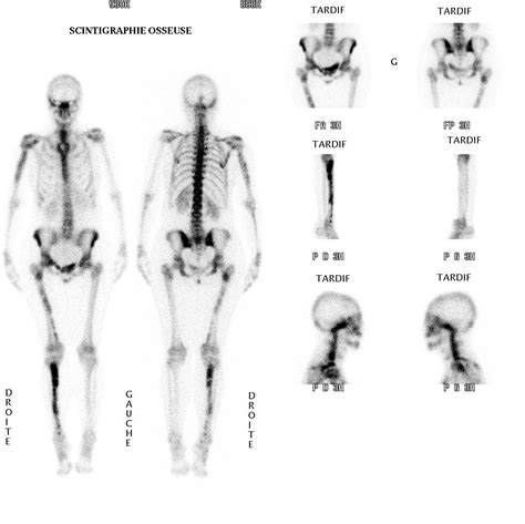 Dysplasie Fibreuse Polyostotique Hemimélique Droite