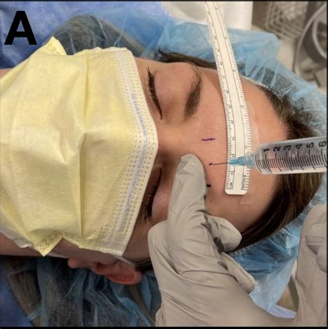 Scalp Block Technique Indications And Clinical Use The Anesthesia