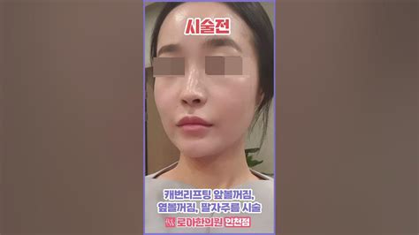 직원이 직접 받아본 캐번리프팅의 진짜 효과실리프팅후기shorts캐번리프팅효과 Youtube