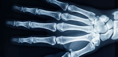 Eular And Acr Classification Criteria For Calcium Pyrophosphate Deposition Disease Conexiant