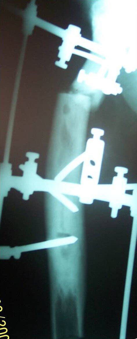 Extension At The Proximal Osteotomy Download Scientific Diagram Extension At The Proximal Osteotomy Download Scientific Diagram