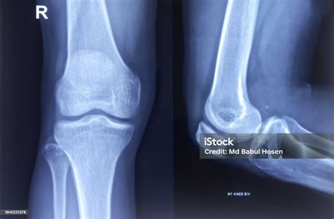 Knee Joint Xray Ap And Lateral View Normal Skeletal Normal Findings