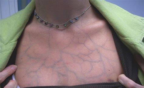 Vascular Ehlers Danlos Syndrome Uk Registered Charity