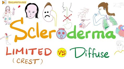 Limited Scleroderma Crest Vs Diffuse Scleroderma Rheumatology Youtube