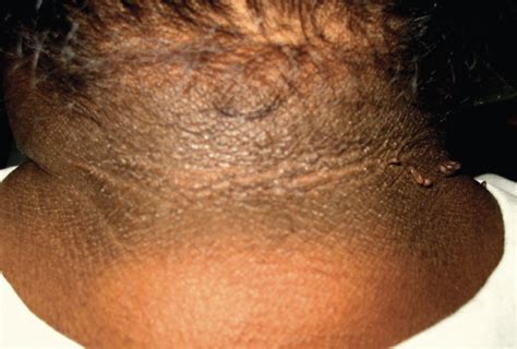 Hyperpigmented Lesions Pediatric Dermatology