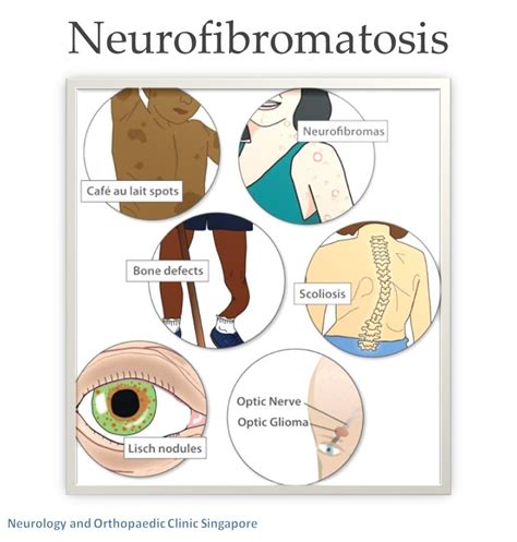 Neurofibromatosis Comprehensive Sg Nerve Clinic