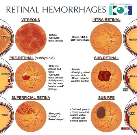 Retinal Hemorrhages A Diagnostic Sign Of Systemic Disorders Mohammed