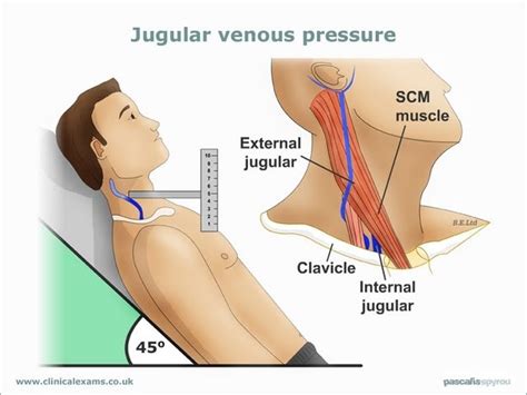 Jugular Venous Distention Its A Bird Its A Plane Its A Vein