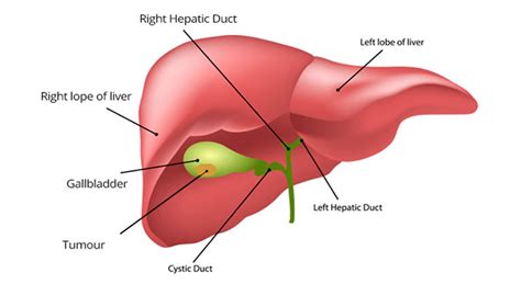 Gallbladder Cancer