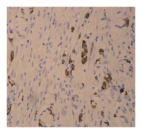 Goblet Cell Carcinoid Of The Appendix Immunohistochemically The