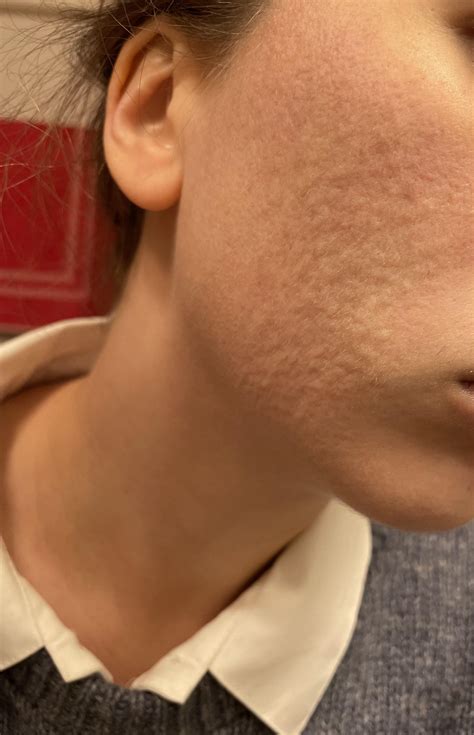 Goosebump Skin Appearance South Moon Keratosis Pilaris Repair Cream