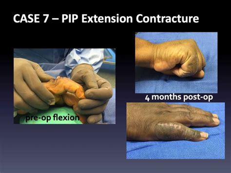 Case 7 Pip Extension Contracture Virak Orthopedics