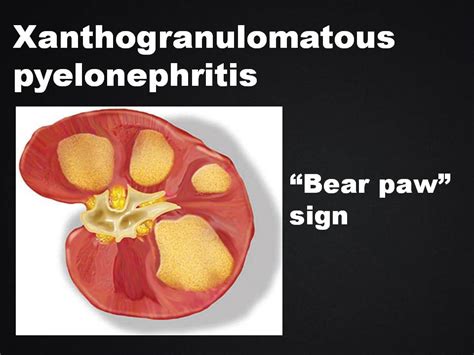 Xanthogranulomatous Pyelonephritis Radiology Classroom