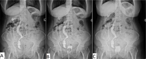 A Antegrade Nephrostogram Shows Dilated And Tortuous Right Ureter Download Scientific