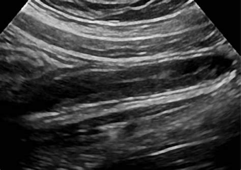 Pediatrics 9 1 Pediatric Abdomen And Retroperitoneum Case 9 1 7 Appendix Ultrasound Cases