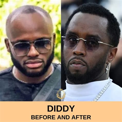 Diddy Hair Transplant Hair Center Of Turkey