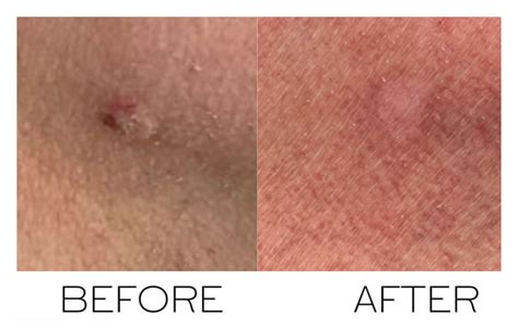 Cryotherapy Cryosurgery Estheva Medical Aesthetic Clinic