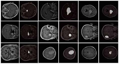 Dynamic Focus On Tumor Boundaries A Lightweight U Net For Mri Brain Tumor Segmentation