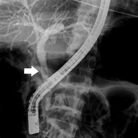 Initial Endoscopic Retrograde Cholangiopancreatography Findings Defect Download Scientific