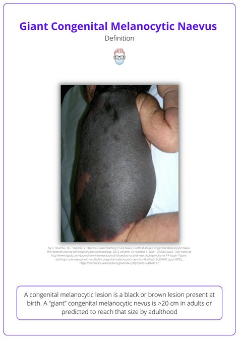 Congenital Melanocytic Naevus Features And Management
