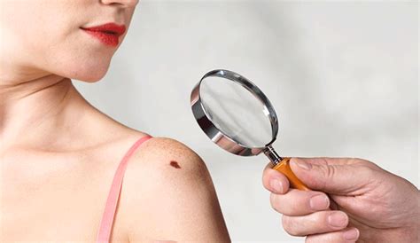 Почему появляются родинки и нужно ли их удалять