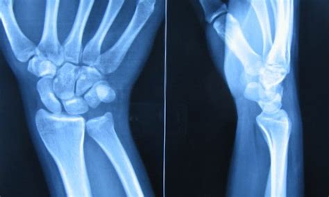 Normal Wrist X Ray Bone And Spine