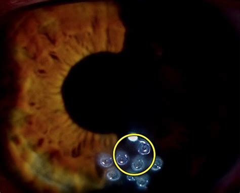 Outcomes Of Conductive Keratoplasty Combined With Corneal Crosslinking